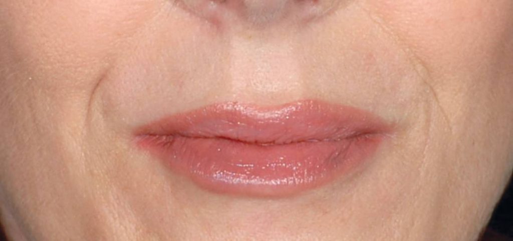 Restylane Dermal Filler - Anti-aging treatment in Orange County