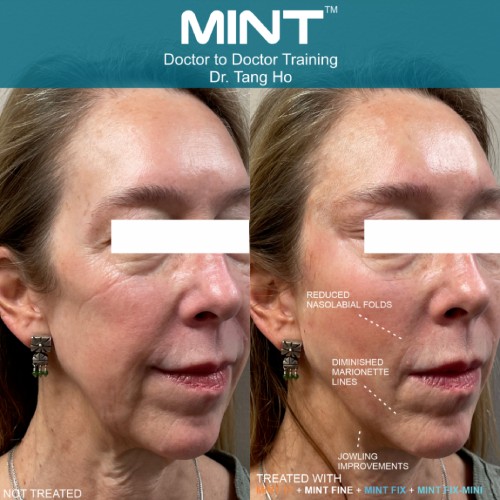 PDO Thread Lift - Best Treatment To Reduce Jowls in Orange County