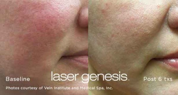 Laser Genesis | Benefits | Cost | Orange County