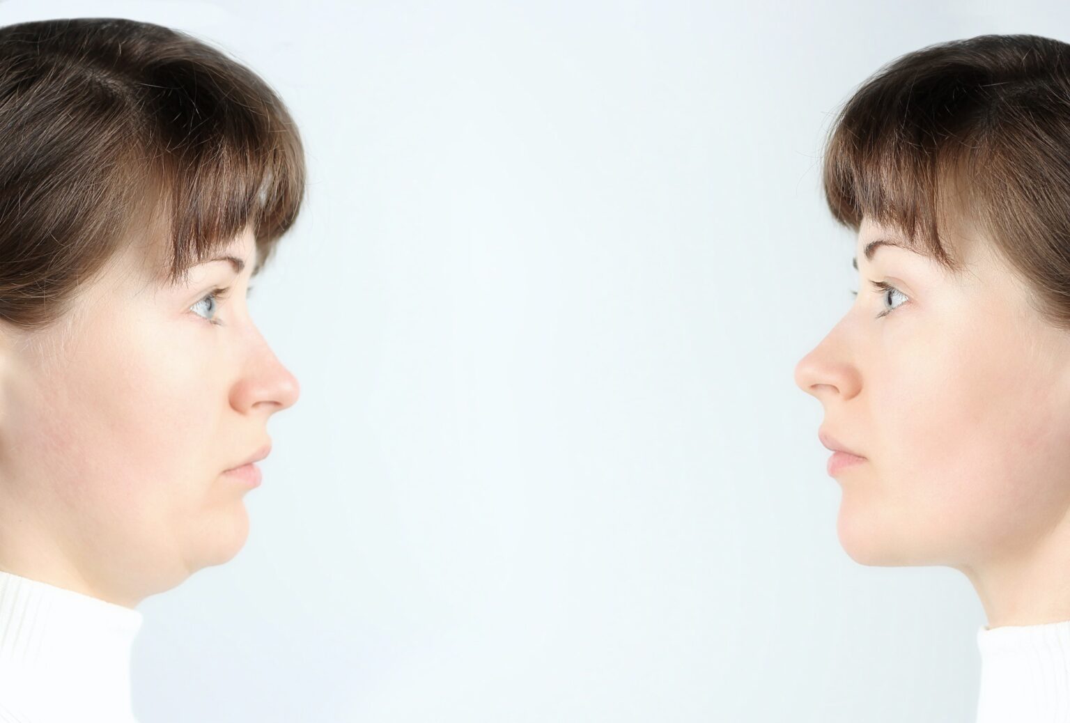 Understanding The Causes And Treatment Of Double Chin
